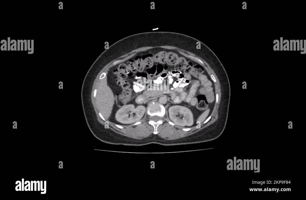 Abdominal tumor Stock Videos & Footage - HD and 4K Video Clips - Alamy