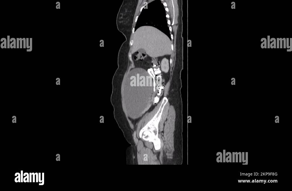 Abnormal ct of abdomen Stock Videos & Footage - HD and 4K Video Clips ...