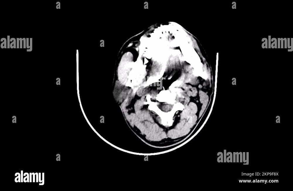 Abnormal ct of brain Stock Videos & Footage - HD and 4K Video Clips - Alamy