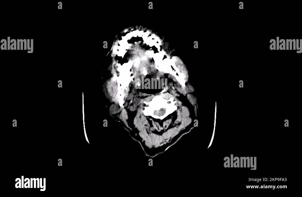 Contusión cerebral Stock Videos & Footage - HD and 4K Video Clips - Alamy