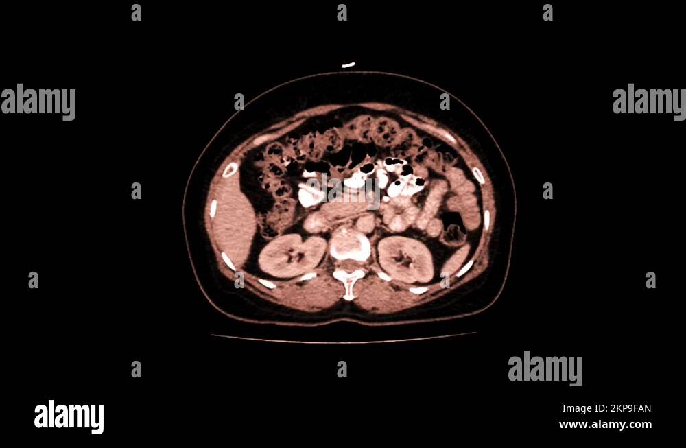 Abdominal cyst, CT scan Stock Video Footage - Alamy