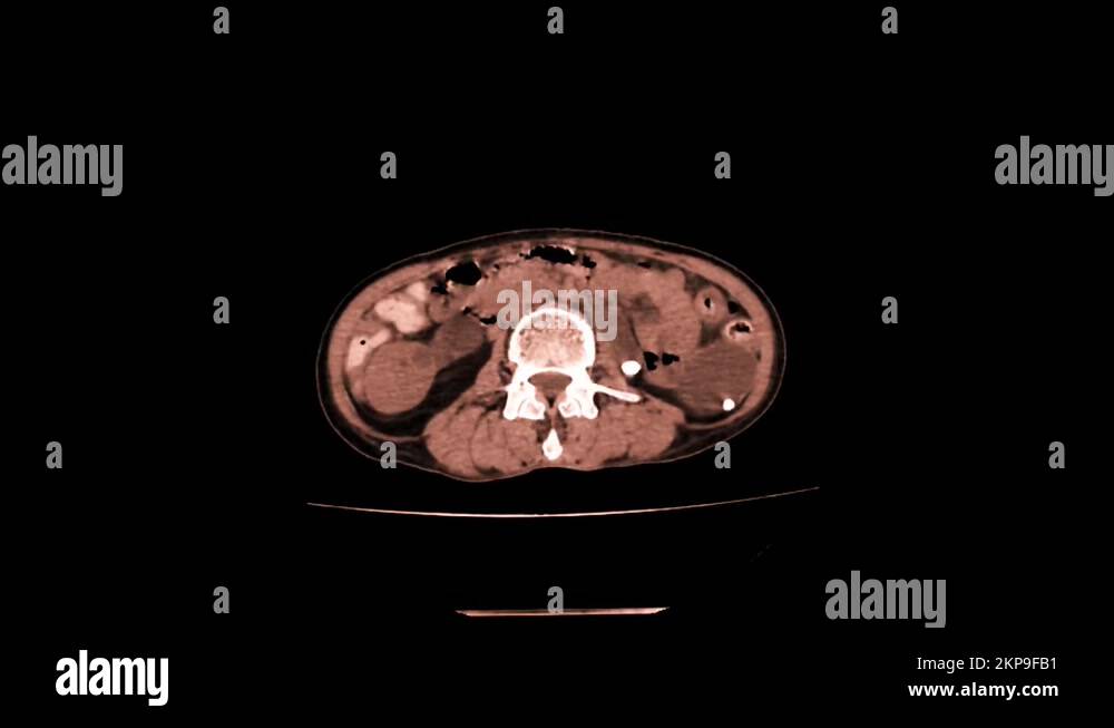 Swollen kidneys, CT scan Stock Video Footage - Alamy