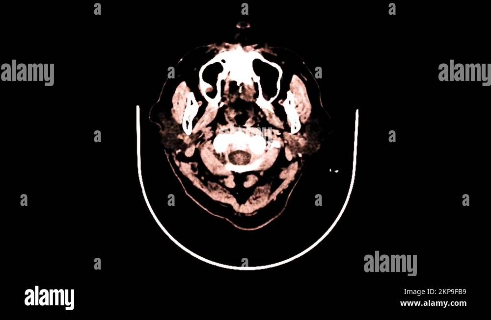 Axial ct scan Stock Videos & Footage - HD and 4K Video Clips - Alamy