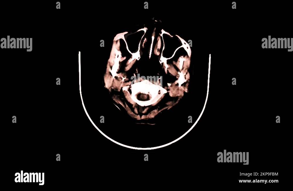 Stroke patient ct scan Stock Videos & Footage - HD and 4K Video Clips ...
