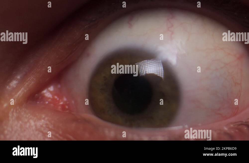 Human eyes with red veins. Potential problems with visceral health by ...