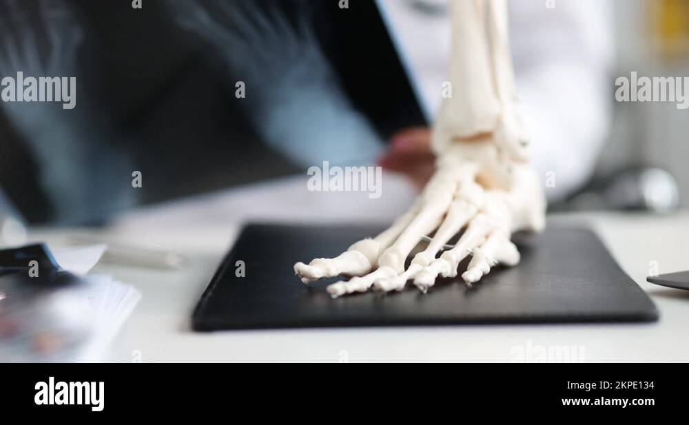 Distal fracture Stock Videos & Footage - HD and 4K Video Clips - Alamy