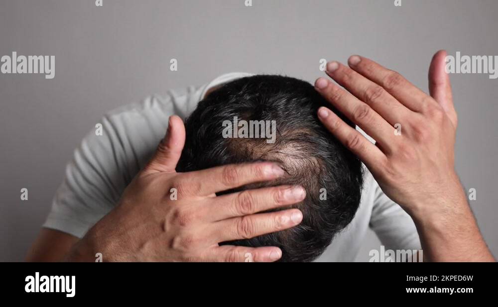 Man Showing Visible Hair Loss Scalp And Examining Bald Patch Stock