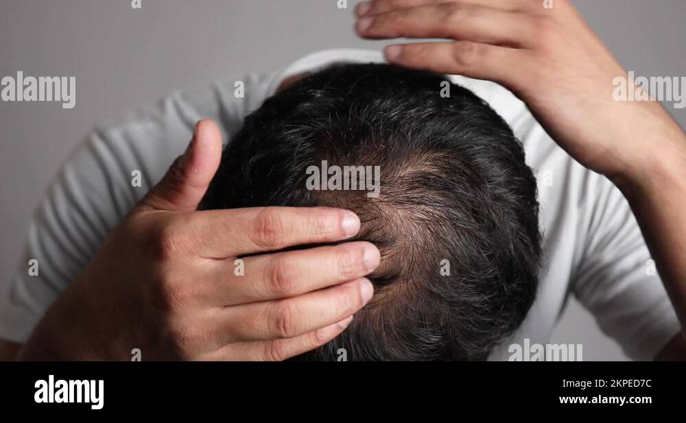 Man With Androgenic Alopecia Hair Loss Disease Male Pattern Baldness Stock Video Footage Alamy