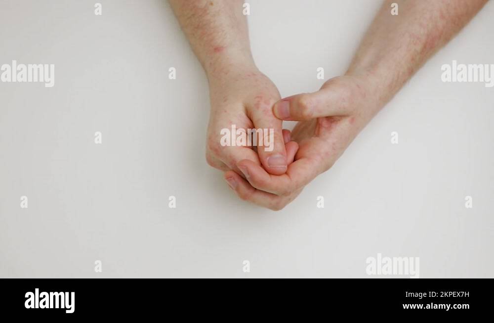 Scratch on human skin Stock Videos & Footage - HD and 4K Video Clips ...