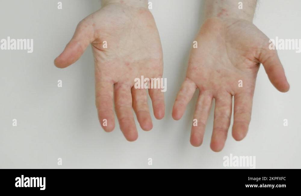Man shows hand palms with allergic reaction or by-effect from taking ...