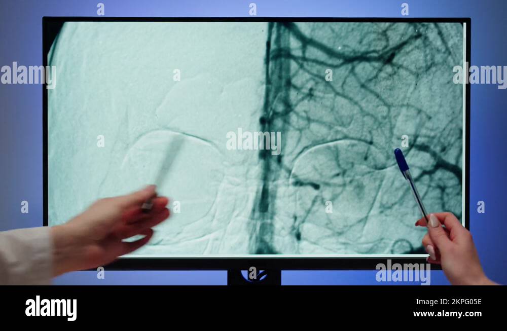 Doctors examining blood vessels X-ray on computer monitor. Magnetic ...