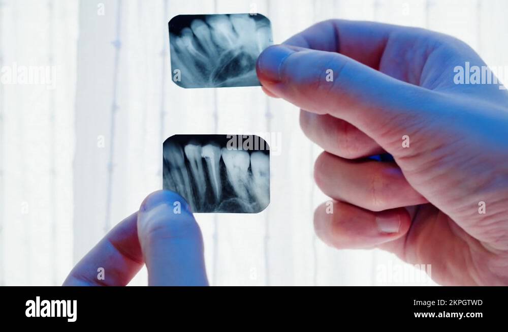 Teeth x-ray close-up. Doctor examining xray of tooth, Magnetic ...