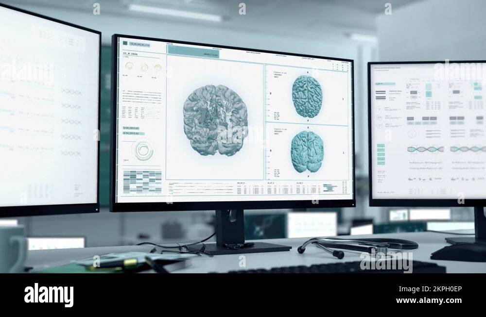 Hospital Computer Checks Brain For Tumor Using X-ray Organ Analysis Ui ...