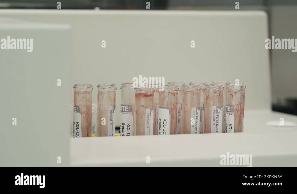 Close Up Of Medical Sample Tubes Stained With Blood Smears In Automated ...