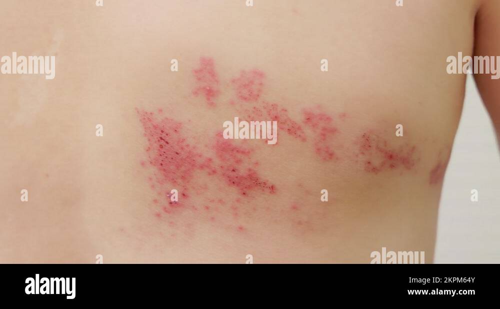 Varicella zoster back shingles Stock Videos & Footage - HD and 4K Video ...