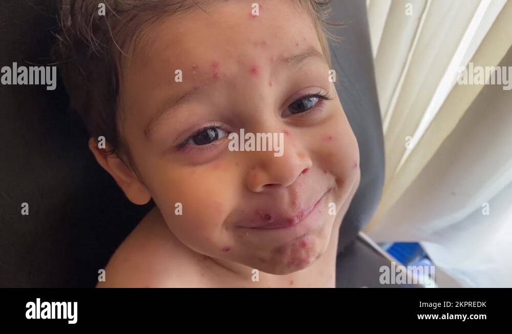 Varicella zoster virus chickenpox Stock Videos & Footage - HD and 4K ...