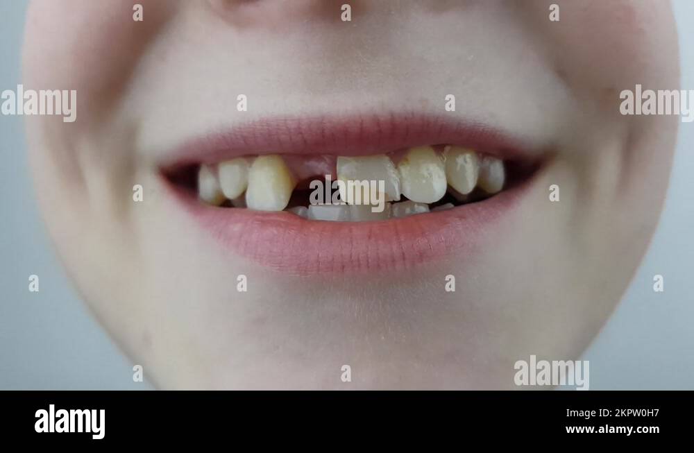 a child without a front tooth is smiling. dental examination dental ...