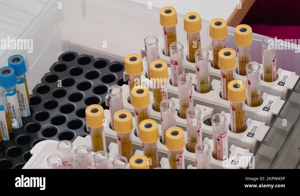 Biochemistry test of the tubes full of blood at the healthcare facility ...