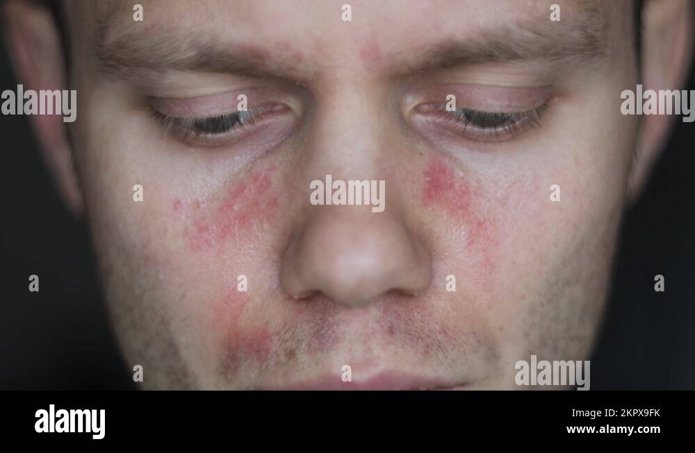 Allergic reaction face Stock Videos & Footage - HD and 4K Video Clips - Alamy