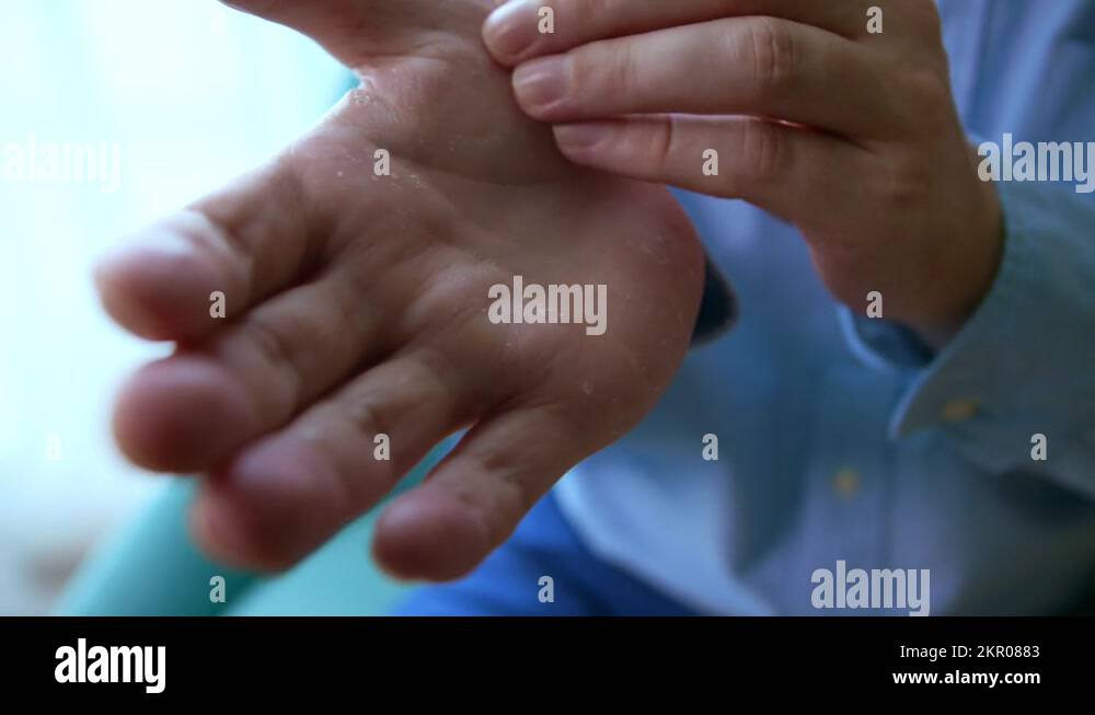 Allergy allergies rash irritation Stock Videos & Footage - HD and 4K ...