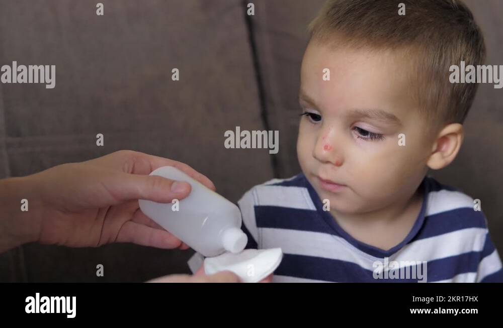 A caring mother applying antiseptic cream to a scratch and a bump on ...