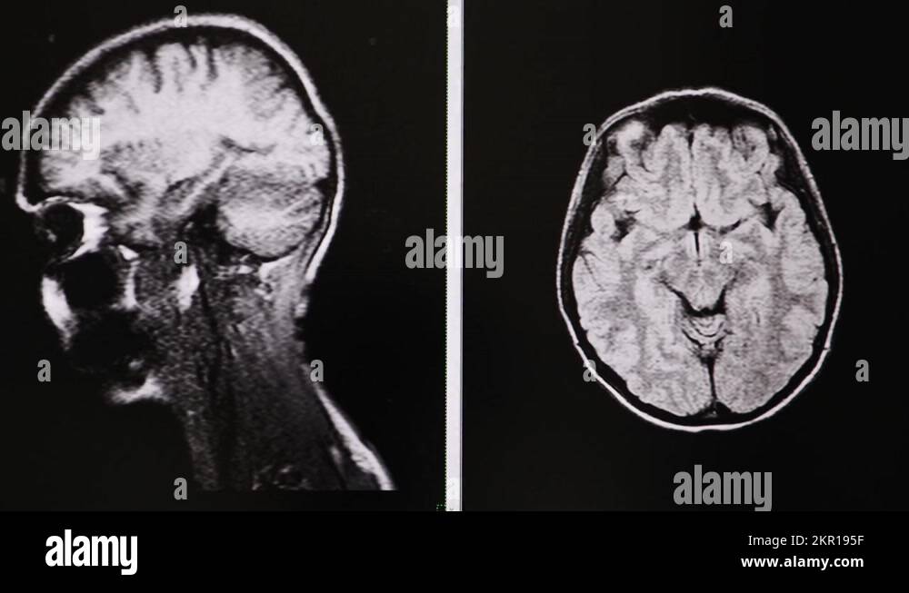 Tomography. MRI scans of the brain. . Medical diagnostic examination ...