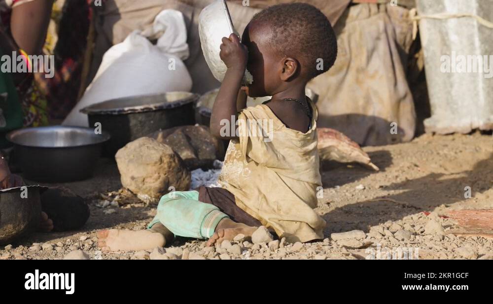 Close-up.Malnourished child due to extreme poverty, drought and climate ...