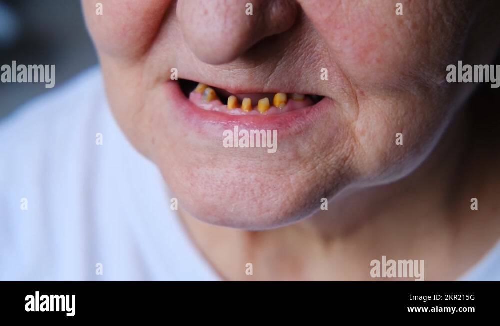Toothless mouth with dental implants. Prosthetics, Orthodontic ...
