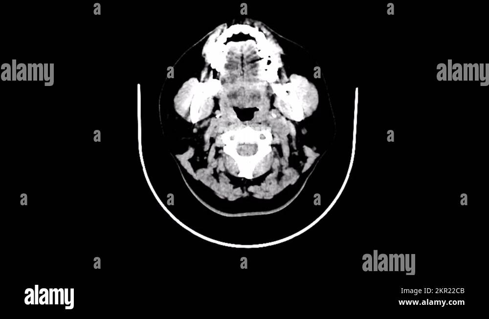 Arachnoid Membrane Stock Videos And Footage Hd And 4k Video Clips Alamy