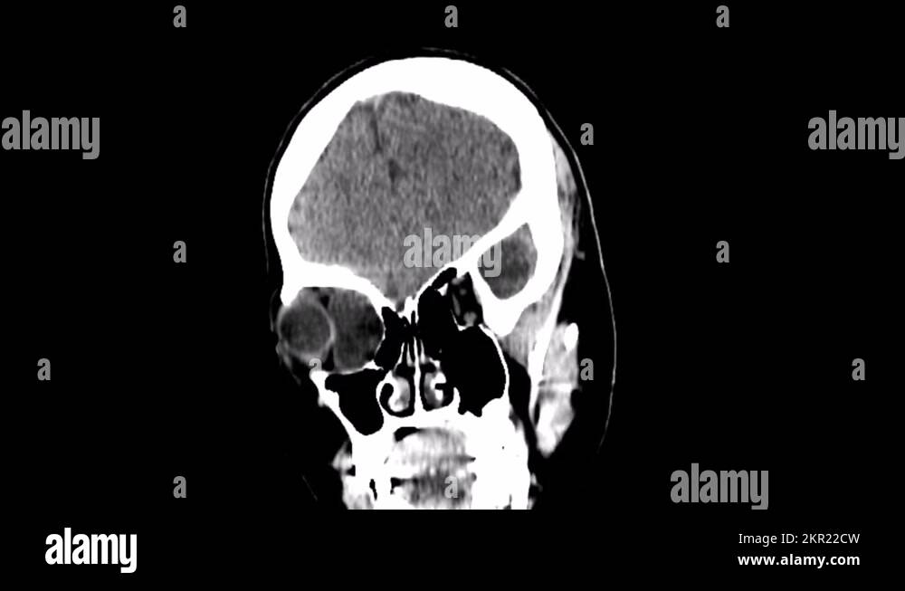 Open-lip schizencephaly, CT scan Stock Video Footage - Alamy