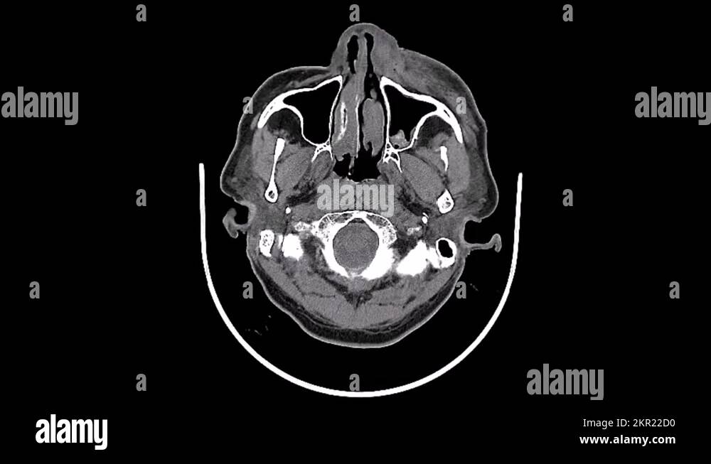 Rupture x ray Stock Videos & Footage - HD and 4K Video Clips - Alamy