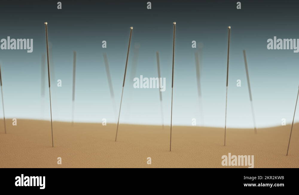 Acupressure needle medicine acupuncture Stock Videos & Footage - HD and ...