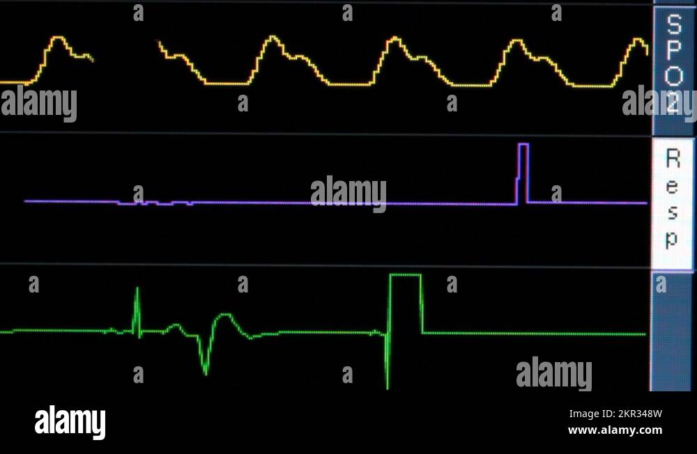 Flatline ecg Stock Videos & Footage - HD and 4K Video Clips - Alamy