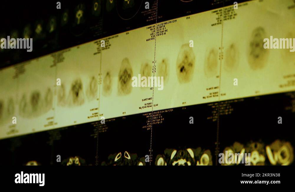 doctor study subclavian pet-ct scan,lymph nodes X-ray,Cancer metastasis ...