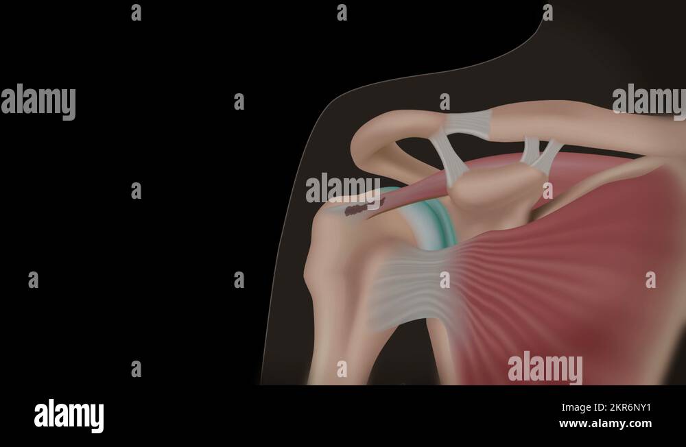 Rotator cuff repair Stock Videos & Footage - HD and 4K Video Clips - Alamy
