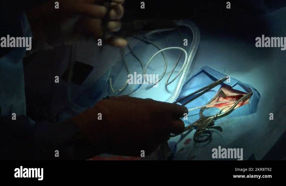 Pacemaker insertion Stock Videos & Footage - HD and 4K Video Clips - Alamy