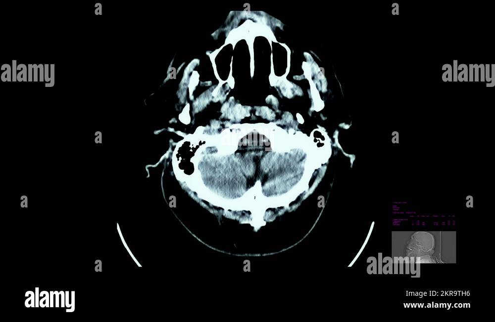 Brain scan, Cerebral venous congestion Stock Video Footage - Alamy