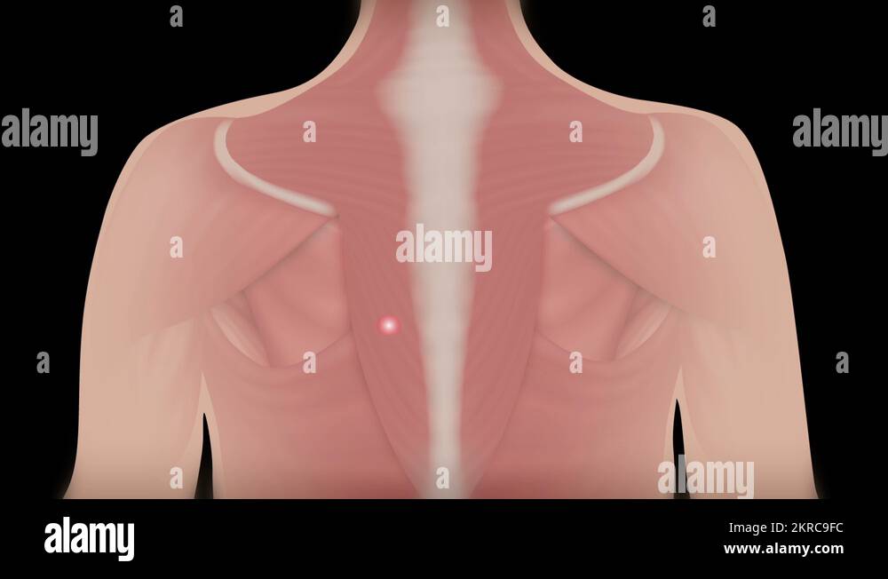 Myofascial trigger points Stock Videos & Footage - HD and 4K Video ...