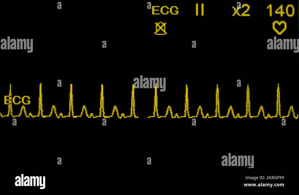 Tachycardia ecg Stock Videos & Footage - HD and 4K Video Clips - Alamy