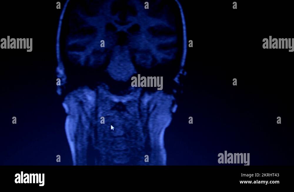 Mri head neck Stock Videos & Footage - HD and 4K Video Clips - Alamy