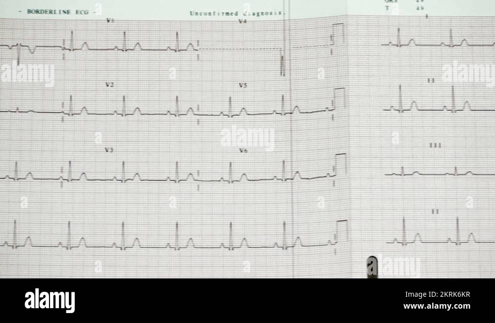 Ekg tracing printout Stock Videos & Footage - HD and 4K Video Clips - Alamy