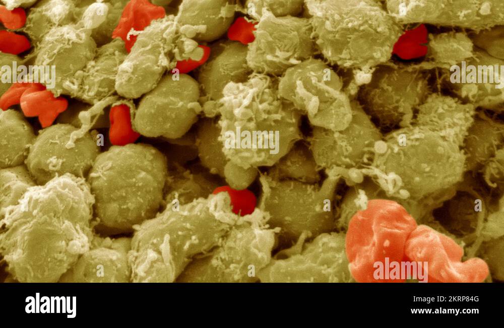 Lymphoma cancer cells Stock Videos & Footage - HD and 4K Video Clips ...