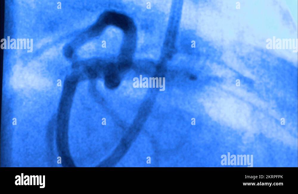 Cardiac angiogram Stock Videos & Footage - HD and 4K Video Clips - Alamy