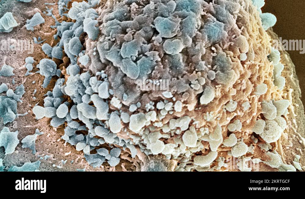 Colon cancer cell Stock Videos & Footage - HD and 4K Video Clips - Alamy