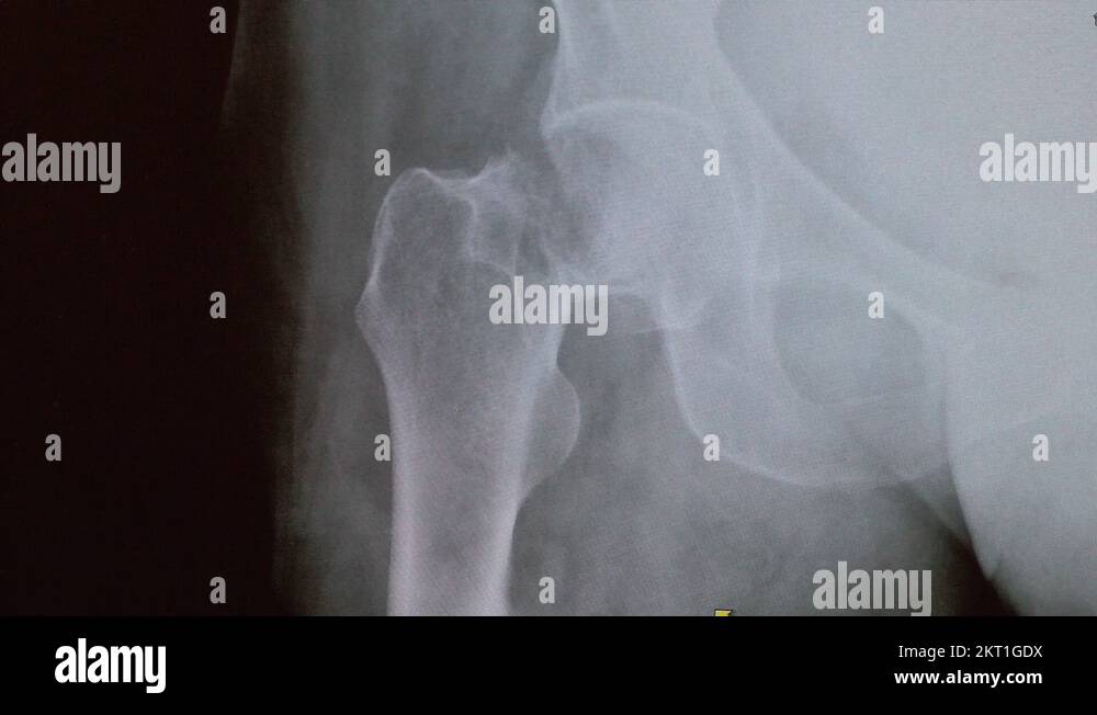 Hip fracture xray Stock Videos & Footage - HD and 4K Video Clips - Alamy