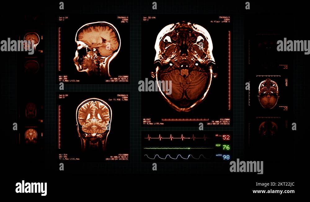 Brain MRI Scan. Amber. 4 in 1 Stock Video Footage - Alamy