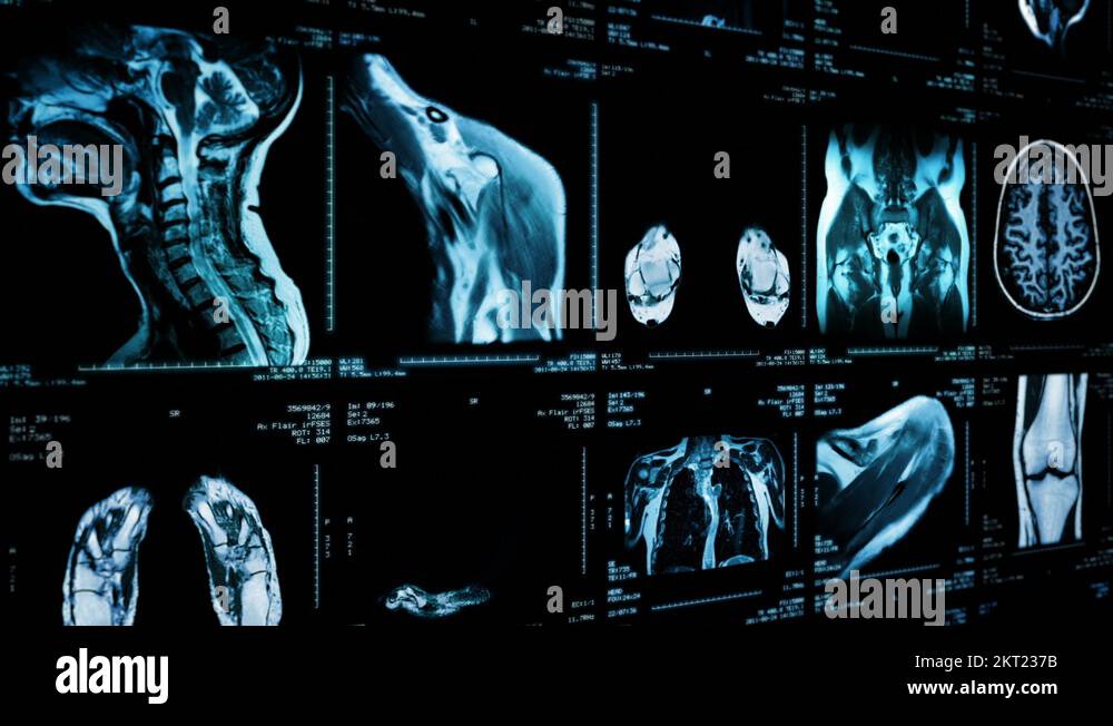 Composite video showing multiple MRI images. Loopable. Black and white ...