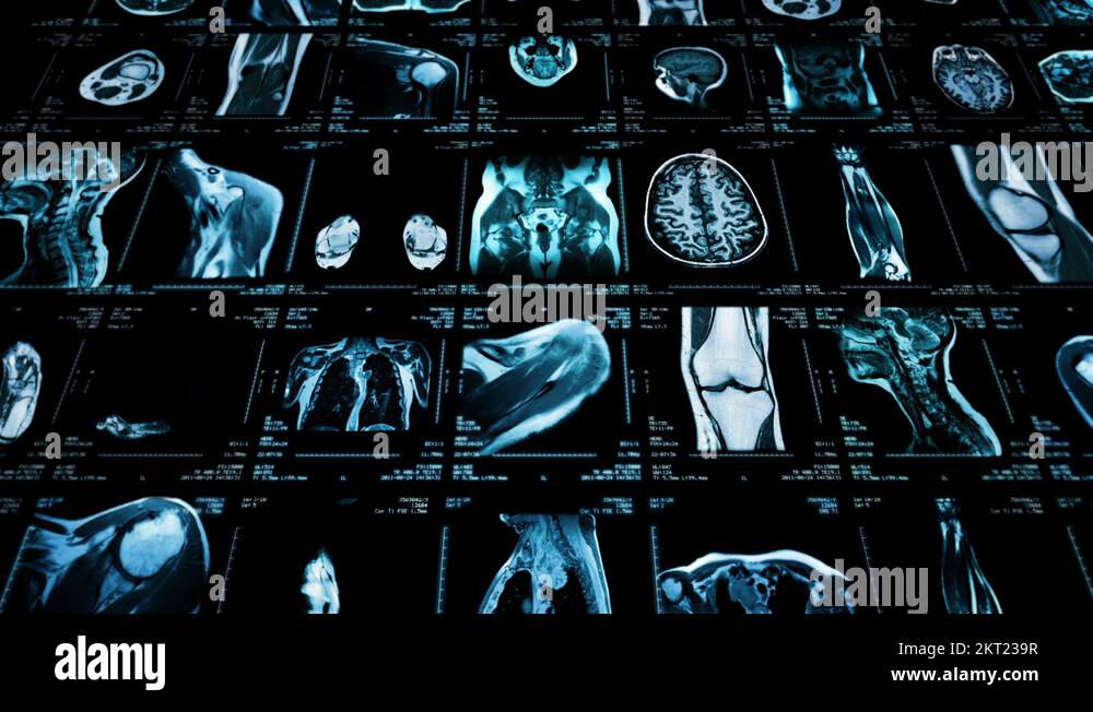 Brain frontal view mri Stock Videos & Footage - HD and 4K Video Clips ...