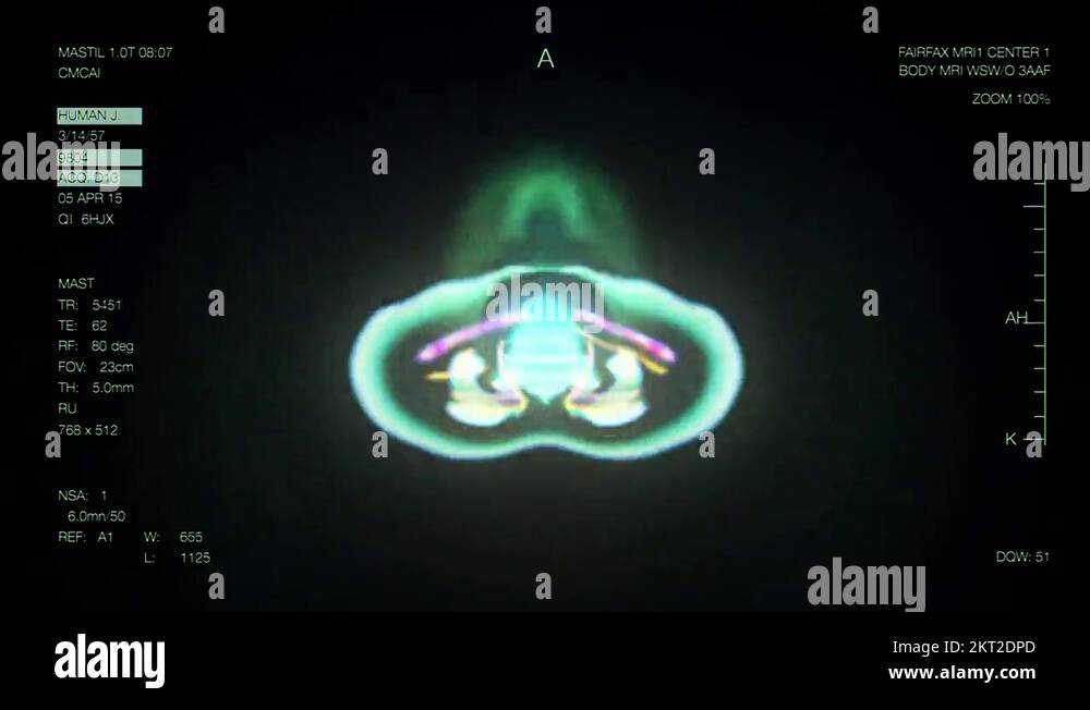 Bone scan of legs and feet Stock Videos & Footage - HD and 4K Video ...