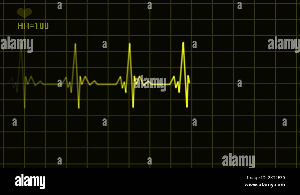 ECG EKG Electrocardiogram Monitor Normal Yellow Stock Video Footage - Alamy